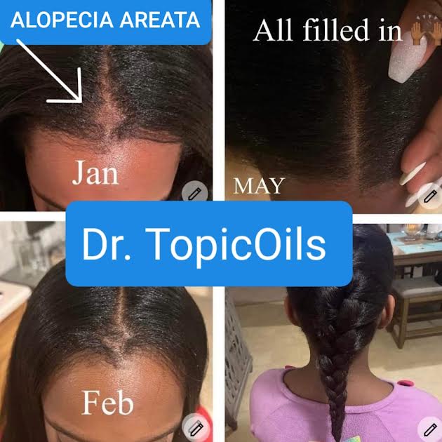 Dr. TopicOils: Alopecia Hair Growth Products That Work (Alopecia Areat
